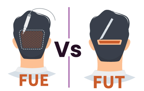 FUT and FUE Hair Transplant Treatment In Navi Mumbai - Nubello ...